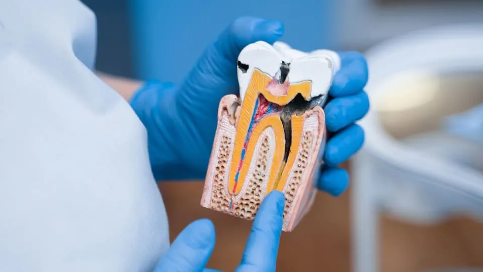 Root Canal Treatment - Mediwell Clinic