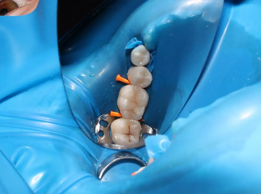 Dental Filling - Mediwell Clinic